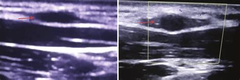 A And B A Hr Usg Showing Enlarged Lymph Nodes In Subcutaneous And