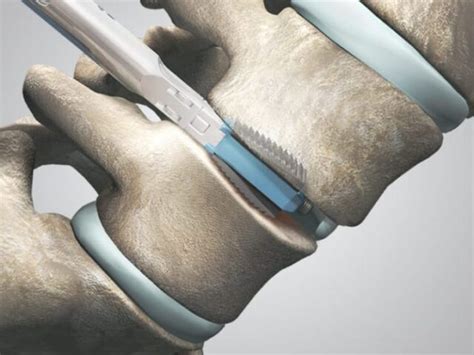 Spinal Medical Devices Orthofix