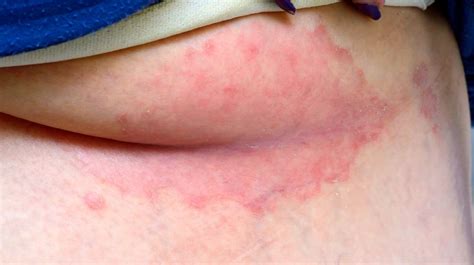 Fungal Rash On Stomach