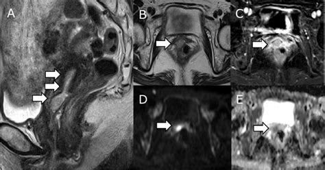 Magnetic Resonance Imaging Of The Polypoid Mass A Sagittal And B