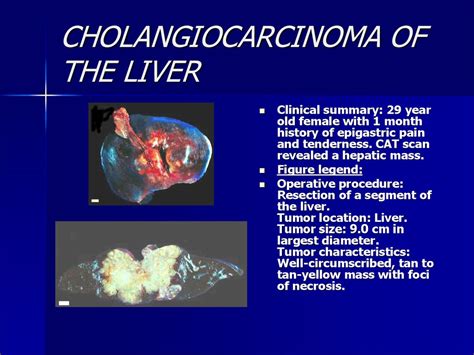 Carcinoma Of The Liver And Pancreas презентация онлайн