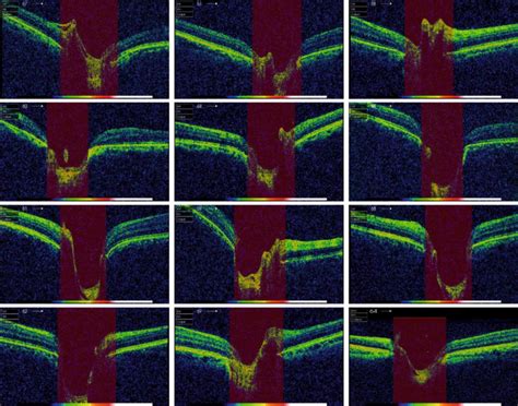 Demonstrates The Sample OCT Images Download Scientific Diagram