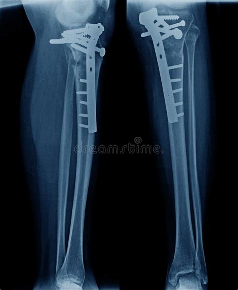 X Ray Image Of Leg Show Tibia Bone Fixation Stock Image Image Of