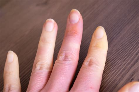 Is Raynauds Disease An Autoimmune Disease Summit Rheumatology