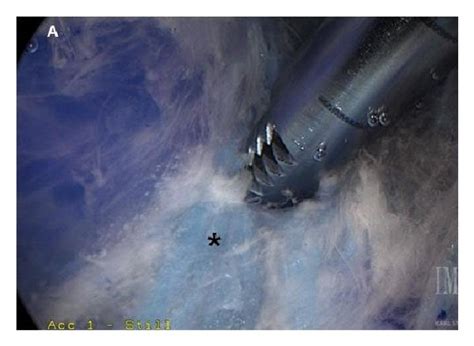 Arthroscopic Images A B And C Demonstrating Arthroscopic