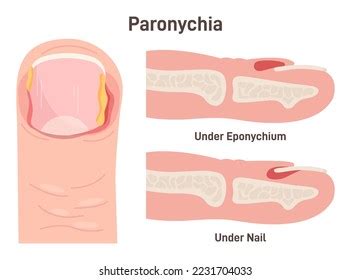 Paronychia Vs Felon Paronychia Paronychia Is An Inflammation Of The