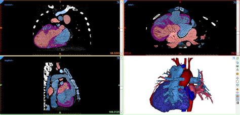 Automated And Semi Automated Segmentation Of Ct On Mimics Innovation Download Scientific