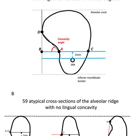 Illustration And Classification Of Cross Sections Of The Alveolar Ridge