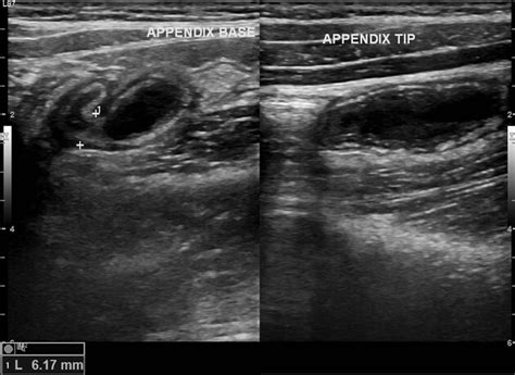 Normal Appendix Ultrasound