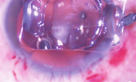 The Iol Was Opacification Before Implantation Iol Intraocular Lens