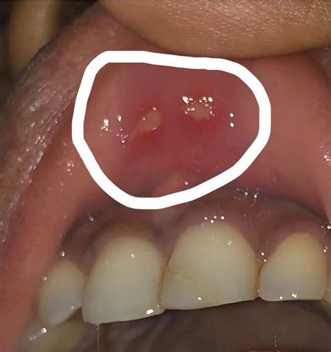 Had Rough Oral Sex That I Stopped Mid Way And Then I See This Bruise