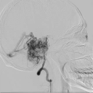 Sagittal View Of Left Vertebral Artery Angiography Shows Download Scientific Diagram