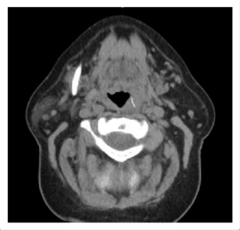 An Axial Non Contrast Ct Scan Demonstrating The Radiopaque Foreign Body