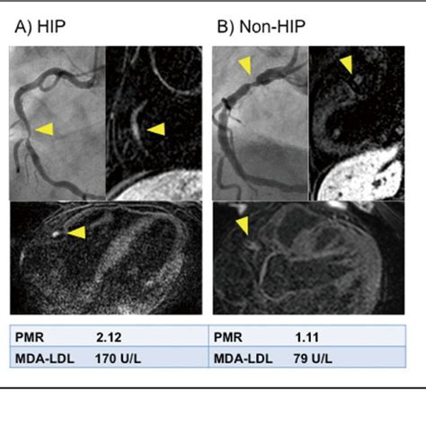Representative Cases Of Hip And Non Hip A A 61 Year Old Man