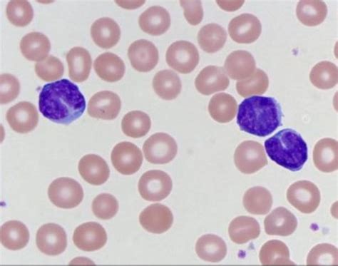 Aamer Hayat On Linkedin Pertussis Infection To Deep Cleaved Lymphocytes