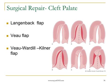 Cleft Palate Lip Bifid Uvula Submucosal Cleft Modified By Dr Nayyarppt