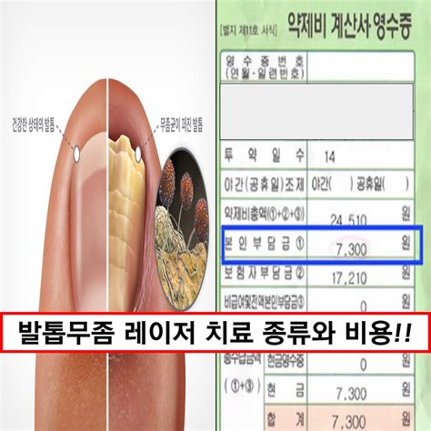 발톱무좀 레이저 종류 와 치료 비용 단점은 지식팩토리