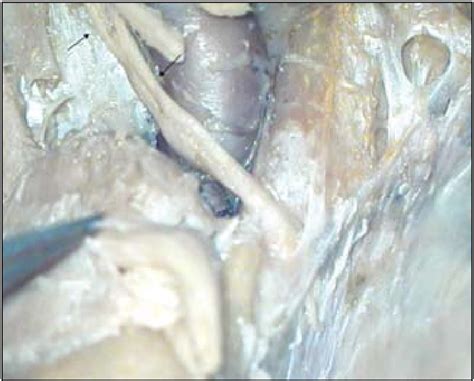 Branching Of The Cavernous Segment Of The Abducens Nerve In A