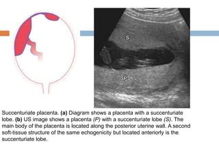 Imaging Of The Placenta Pptx