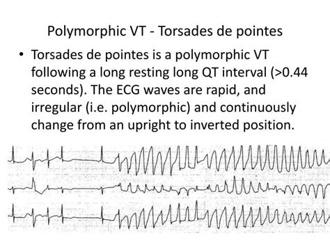 Ppt Ventricular Tachycardia Powerpoint Presentation Id 2156853