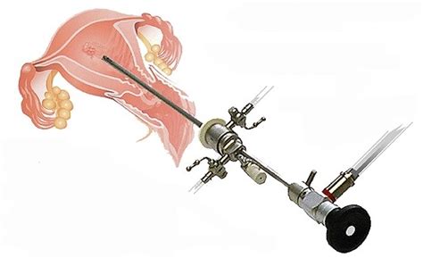 Histeroscopía Mi Gine