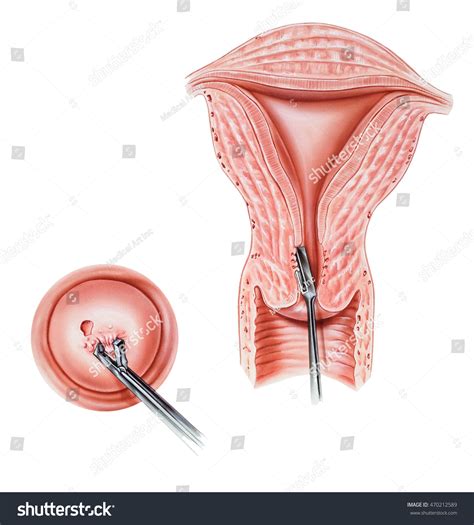 688 Afbeeldingen Voor Biopsy Of Cervix Afbeeldingen Stockfoto‘s En