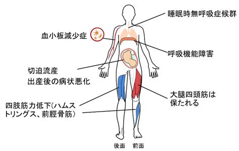 Netherton 症状 ネザートン症候群 治療 Orphanet Netherton Syndrome Xquiaf