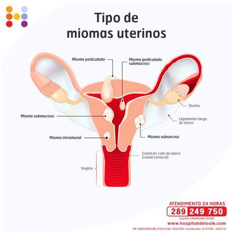 uterine myoma hospital de loulé