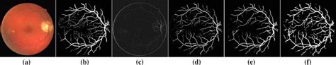 Vessel Segmentation Of Different Methods On A Sample From Drive Download Scientific Diagram