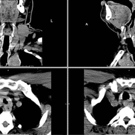 Ct Scan With Multiplanar Reconstructions Of A Patient Affected By