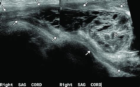 Postoperative Hematoma In A 45 Year Old Man With Scrotal Swelling And