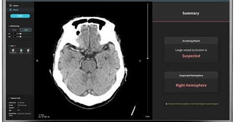 뇌신경질환 진단 Ai 기업 휴런 해외실증사업 우수기업 선정