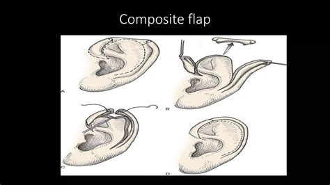 Auricular Reconstruction Pptx