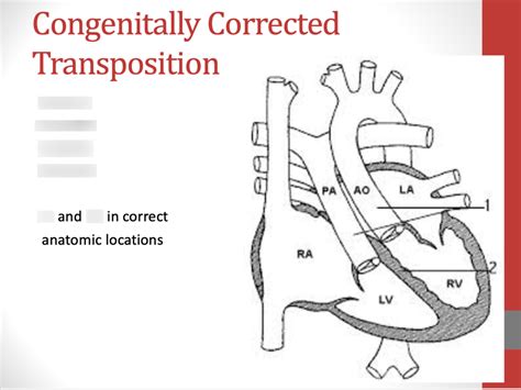 Congenitally Corrected Transposition Diagram Diagram Quizlet