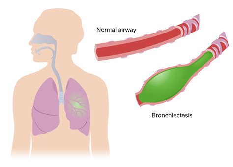 Bronchiectasis Concise Medical Knowledge
