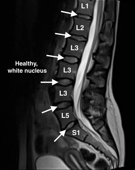 Lumbar Disc Herniation A Comprehensive Overview