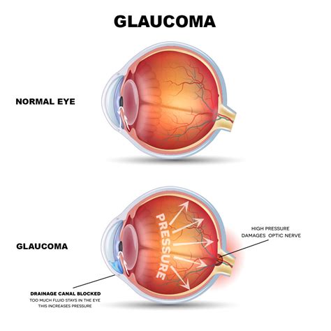 Glaucoma Treatment Gold Coast Coastal Eye Surgeons