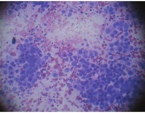 Ct Guided Fine Needle Aspiration Cytology Fnac Of The Lung Nodule Download Scientific Diagram