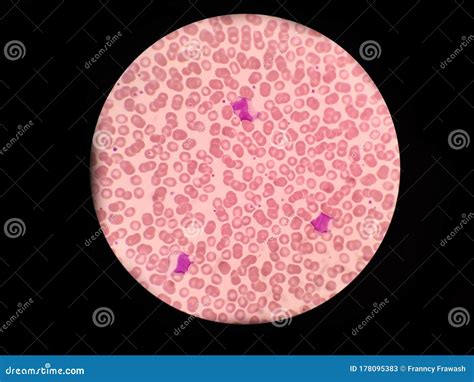 Monocyte And Lymphocyte Red Blood Cell Blood Smear Royalty Free Stock