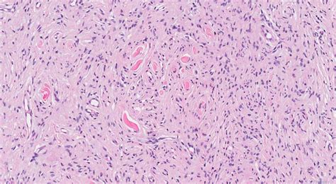 Neurofibroma Of The Skin Ottawa Atlas Of Pathology