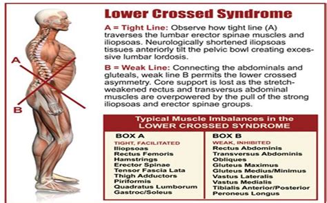 Vladimir Janda Upper Cross Syndrome Dr Bryons Health Blog Upper