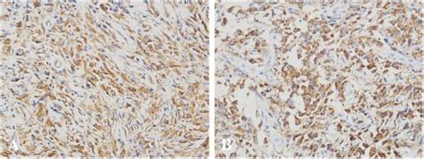 Atypical Conjunctival And Cornea Mass In An Adult Ophthopedia