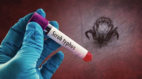 Odisha Over 2800 Cases 8 Deaths From Scrub Typhus