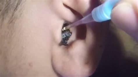 What Causes Really Dark Earwax At Alice Pace Blog