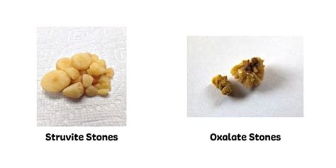 Struvite Stones In Cats