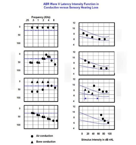 abr wave v latency intensity function in conductive versus sensory