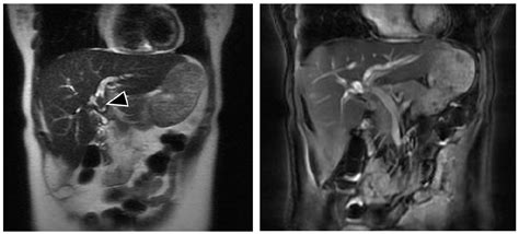 Transjejunal Laparoscopic Assisted Ercp In A Patient With Roux En Y Hepaticojejunostomy