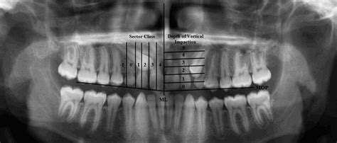Panoramic Radiograph Shows Sector Classification Described By Power And