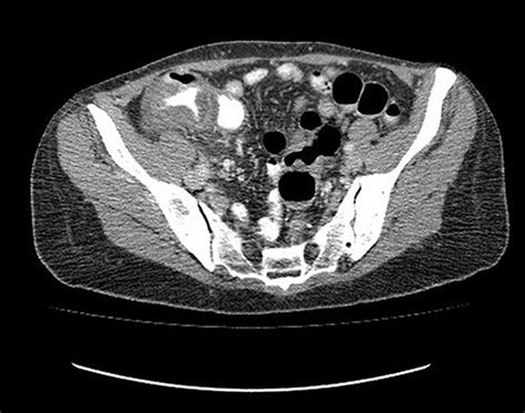Post Polypectomy Syndrome—a Rare Complication In Colonoscopy Procedures A Case Report Pmc