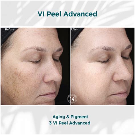 Improve Your Complexion In Just 7 Days With A Vi Peel Seven Trees Med Spa